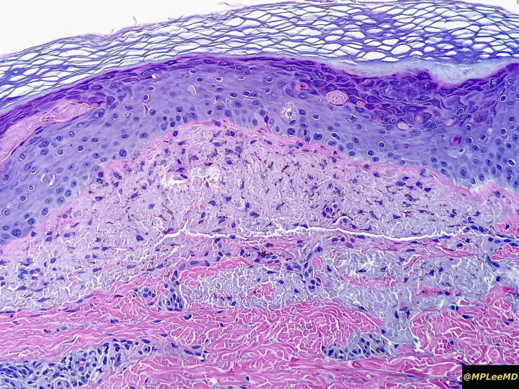 Excoriation Histology