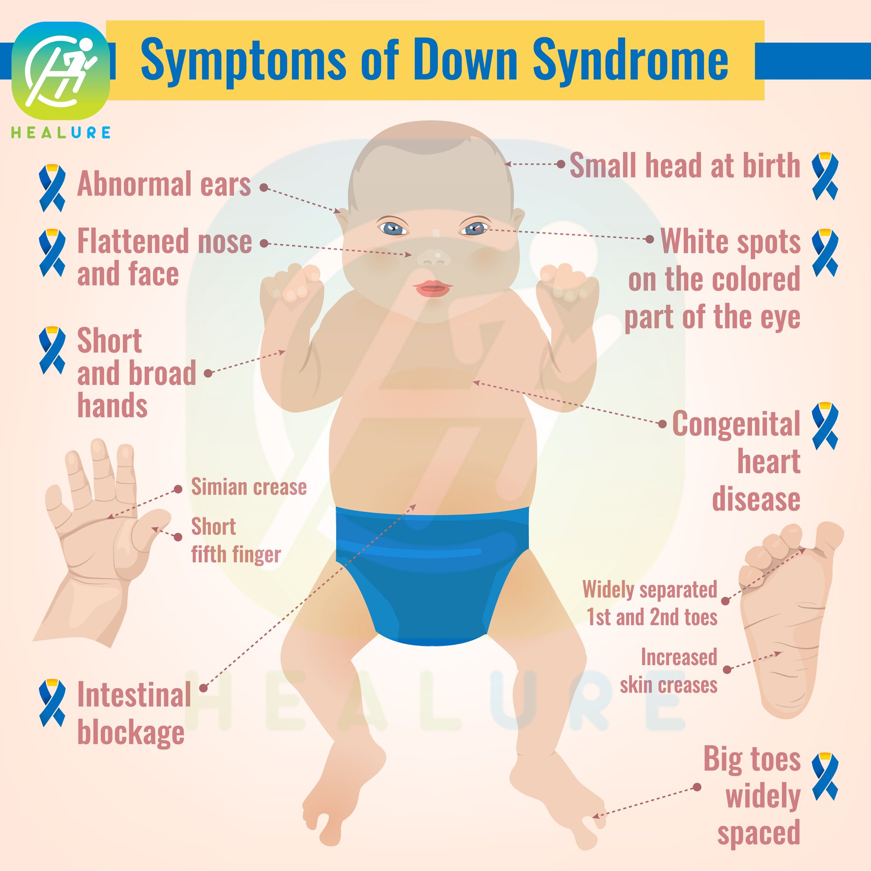 Down Syndrome Symptoms