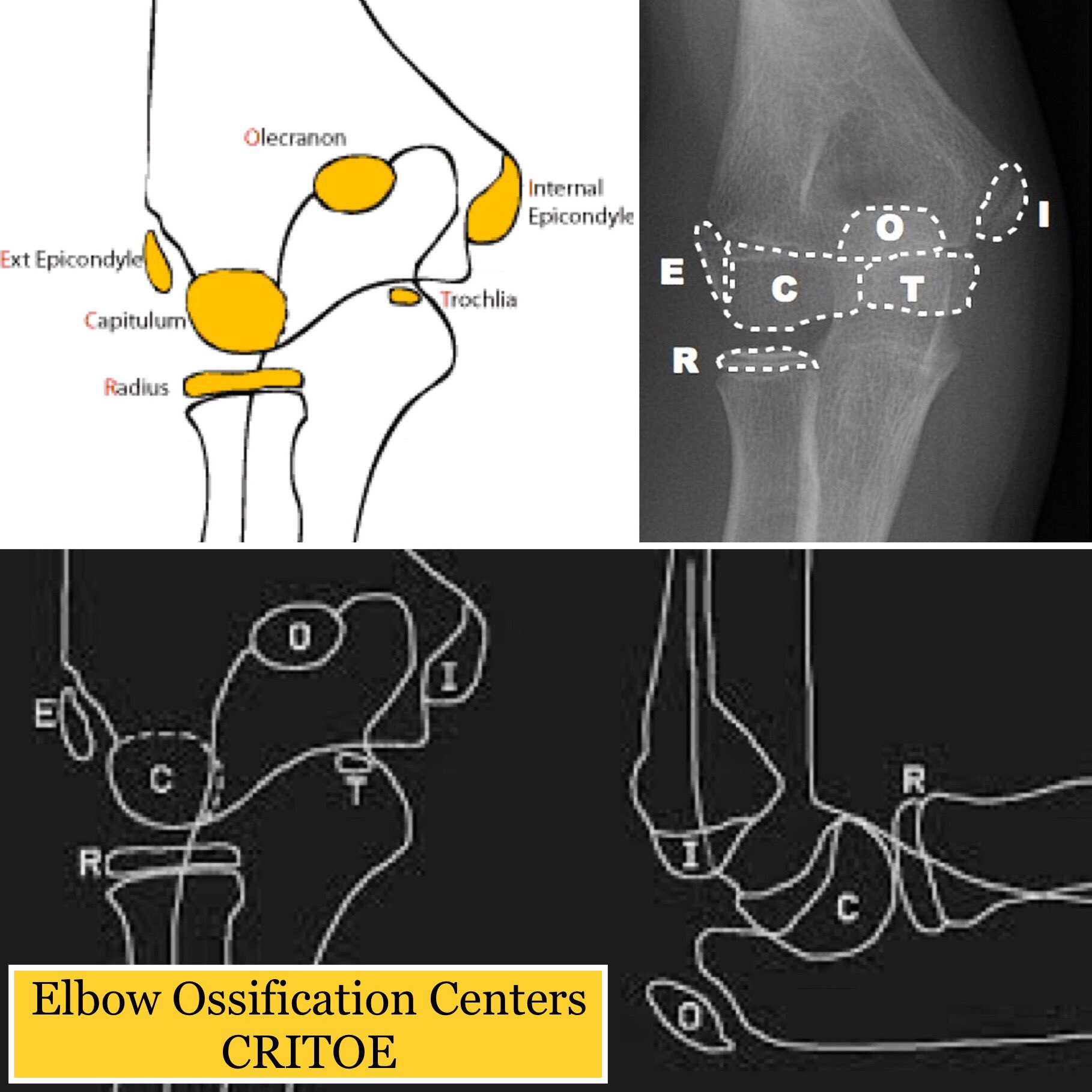 Ossification Centers Elbow