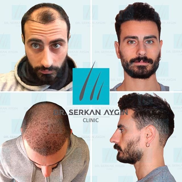 Dr Serkan Aygin On Twitter Would You Like To Get Backtohair Like