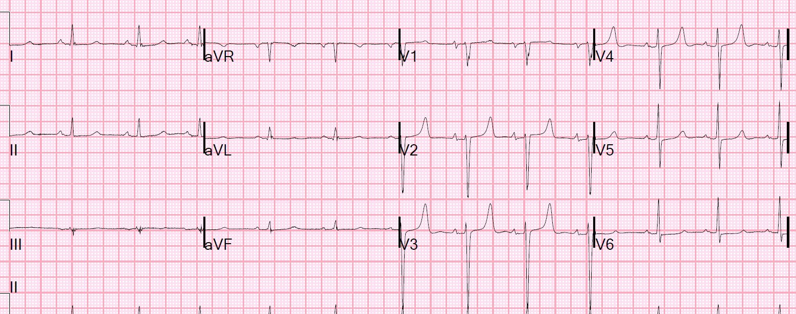 Normal Ecg Reading