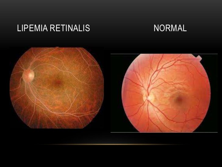 Lipemia Retinalis