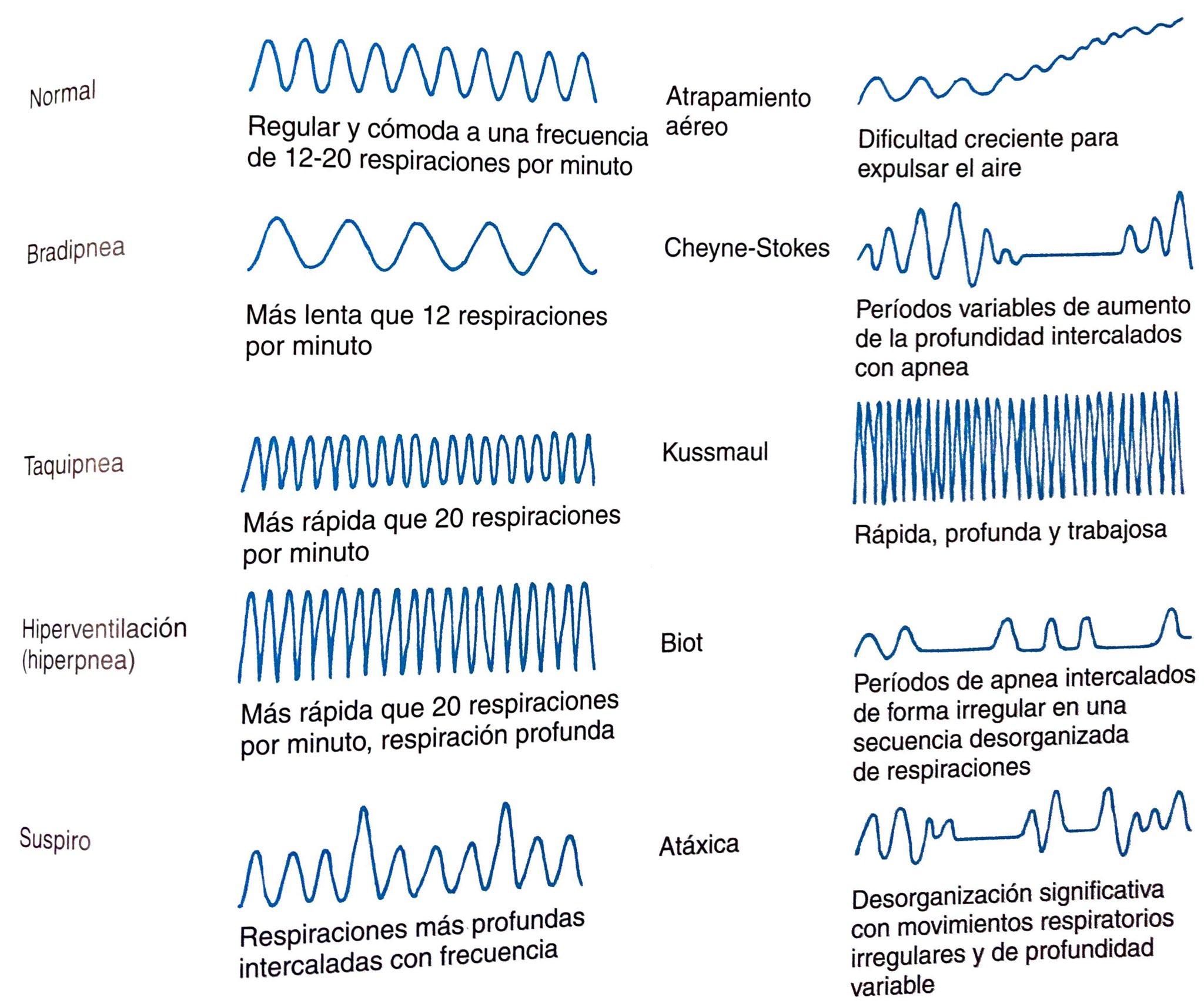 Patrón De Respiración De Kussmaul