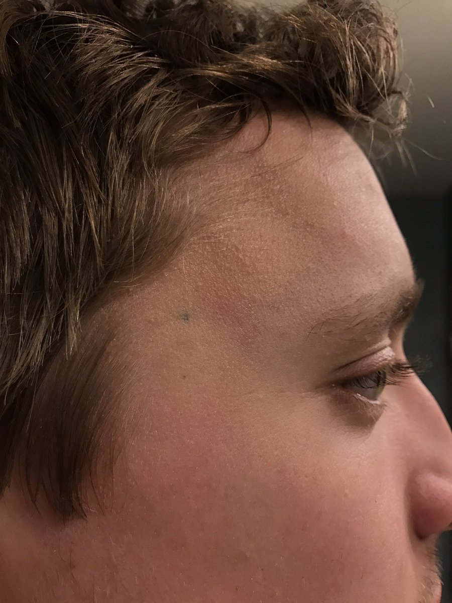 You're Not Alone If You Still See the Stab Mark from the Pencil in School