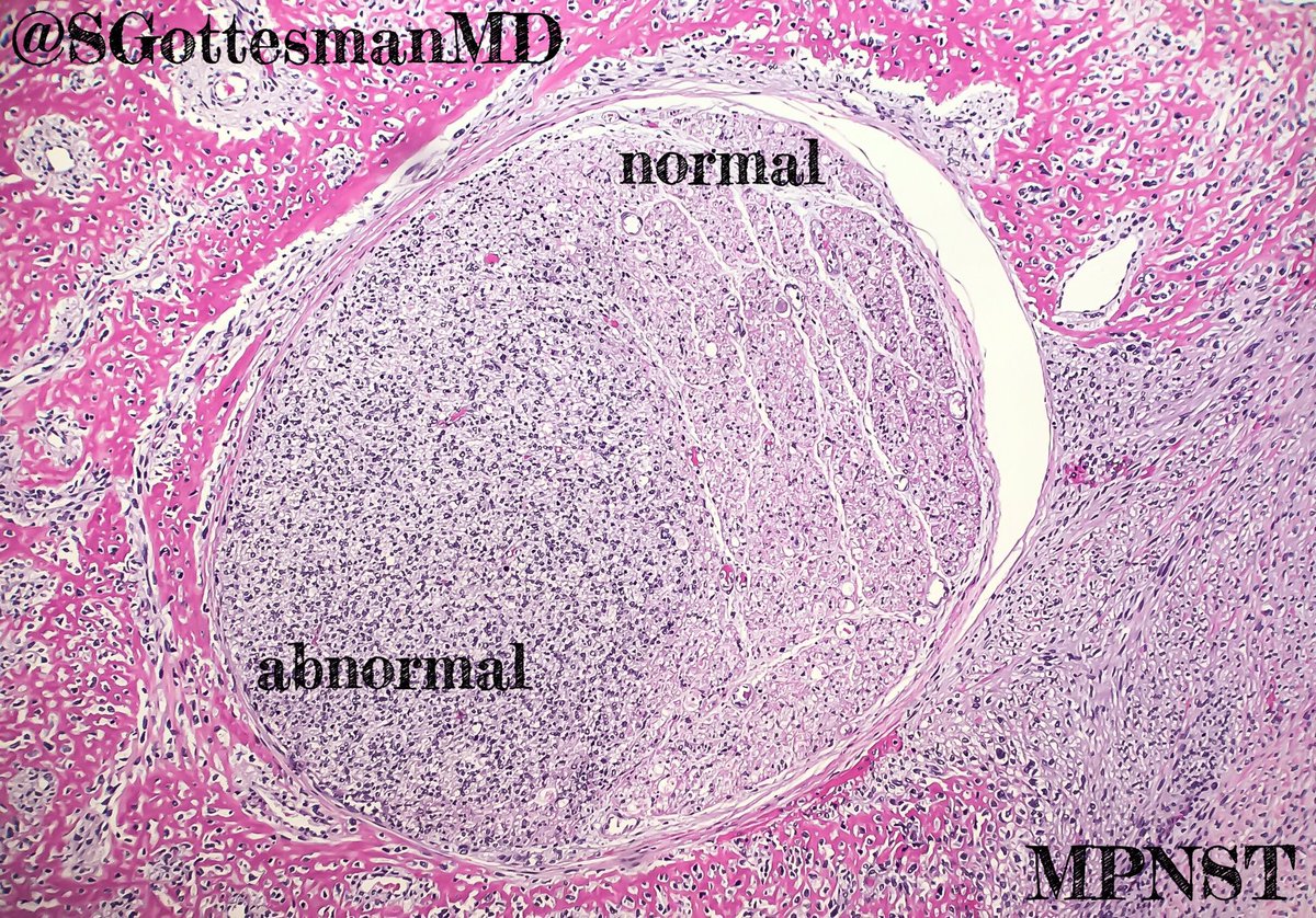 Mpnst Histology
