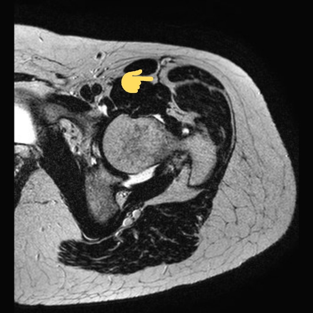 Lateral Femoral Cutaneous Nerve Mri