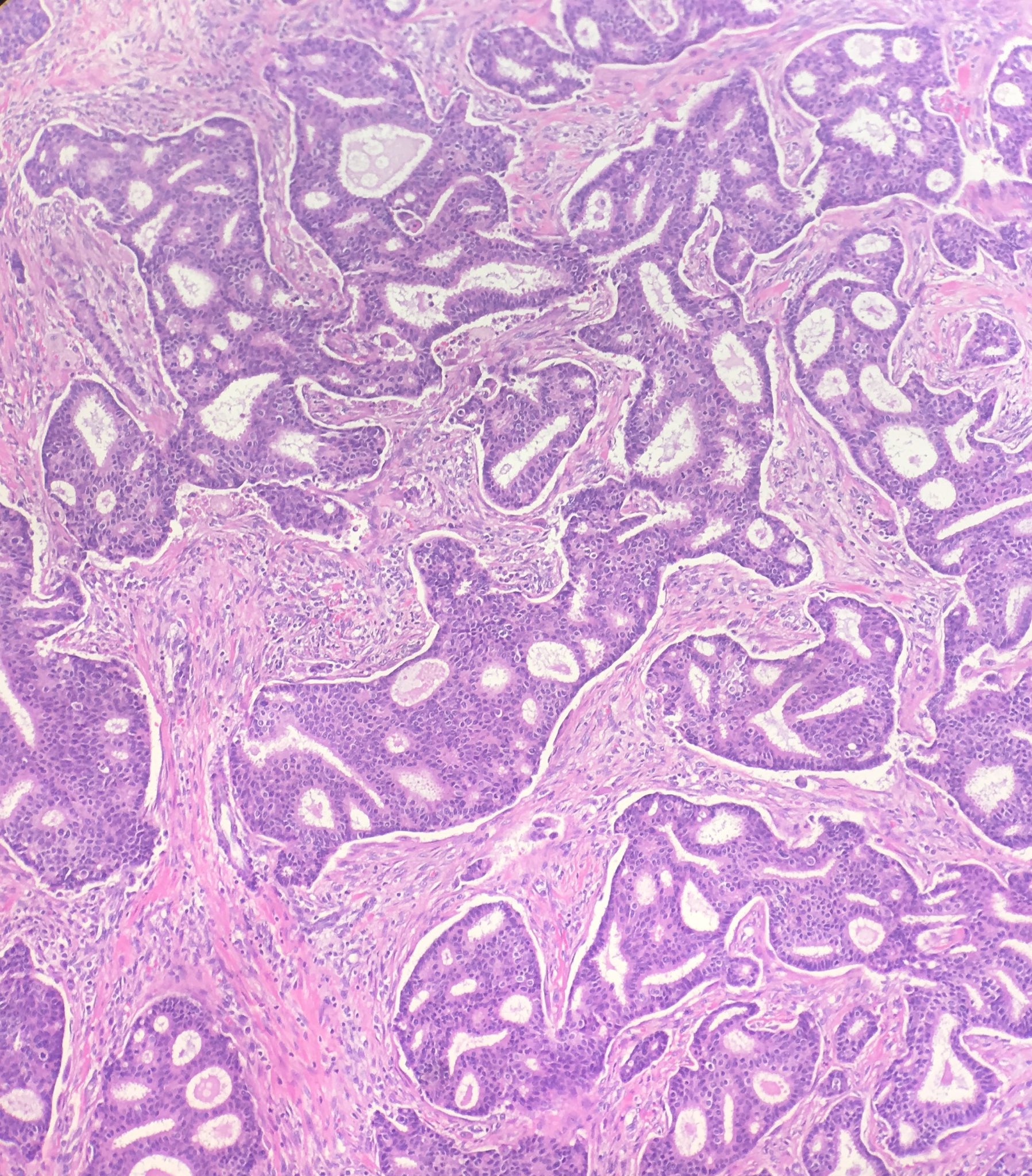 Cribriform Adenocarcinoma