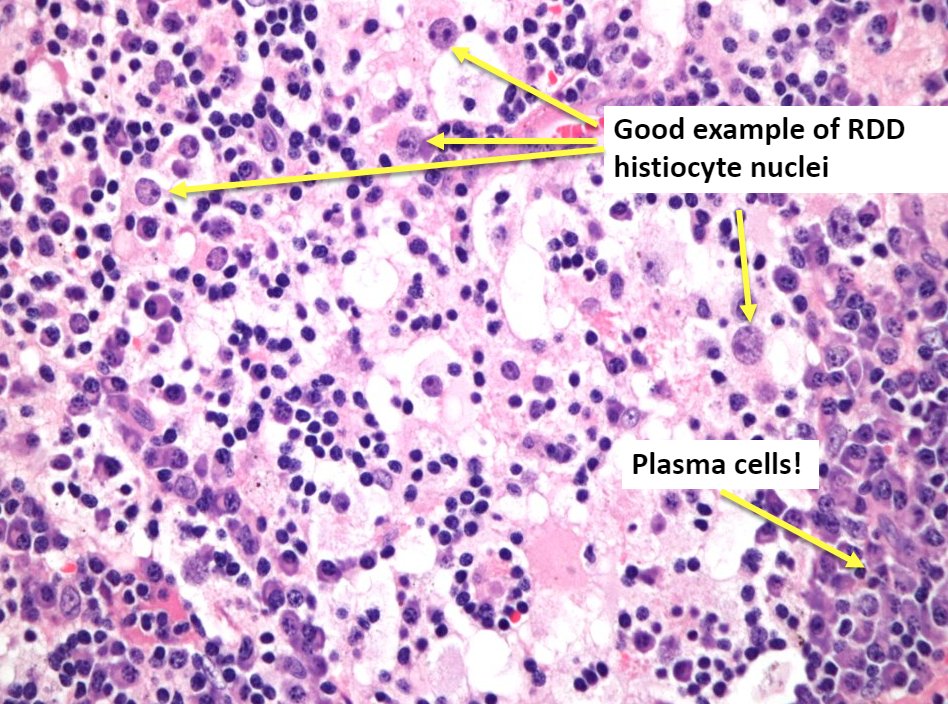 Histiocytes