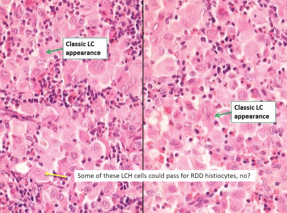 A thread written by @mjcascio: "This was a #LPpath example of Rosai ...
