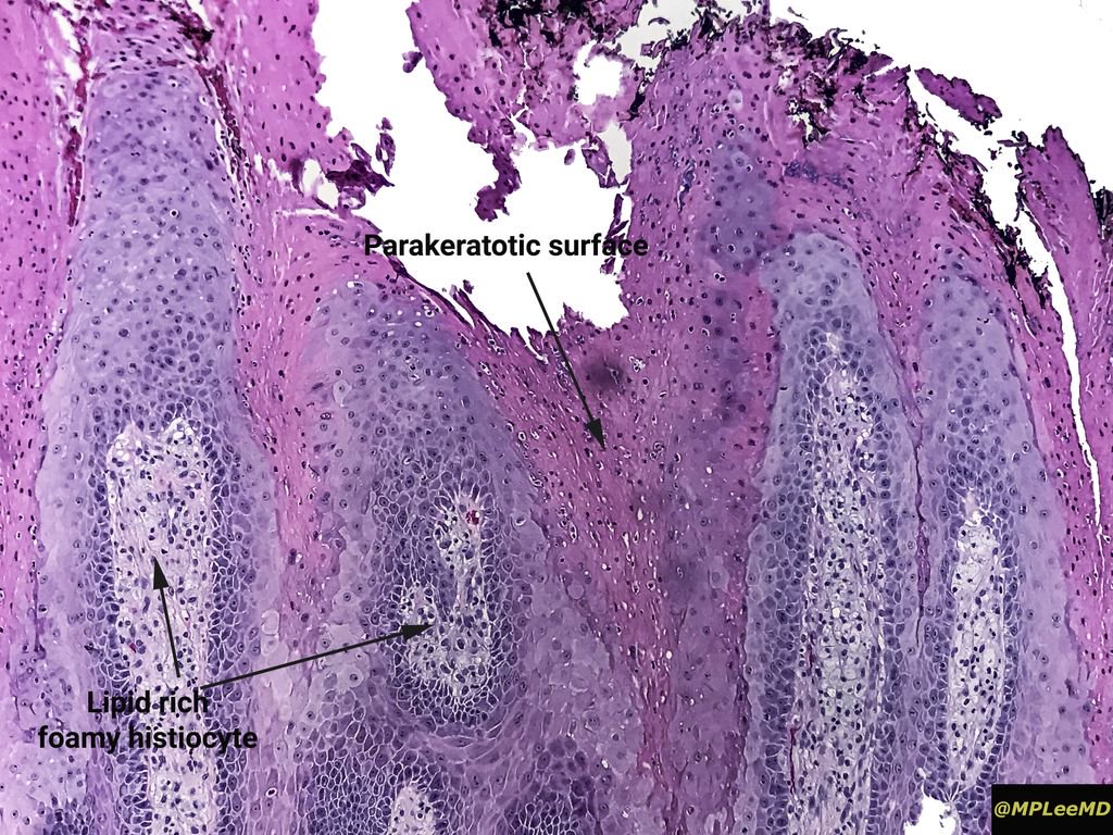 Verruciform Xanthoma Histology