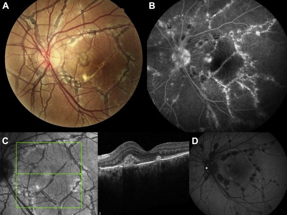 Angioid Streaks Of The Retina