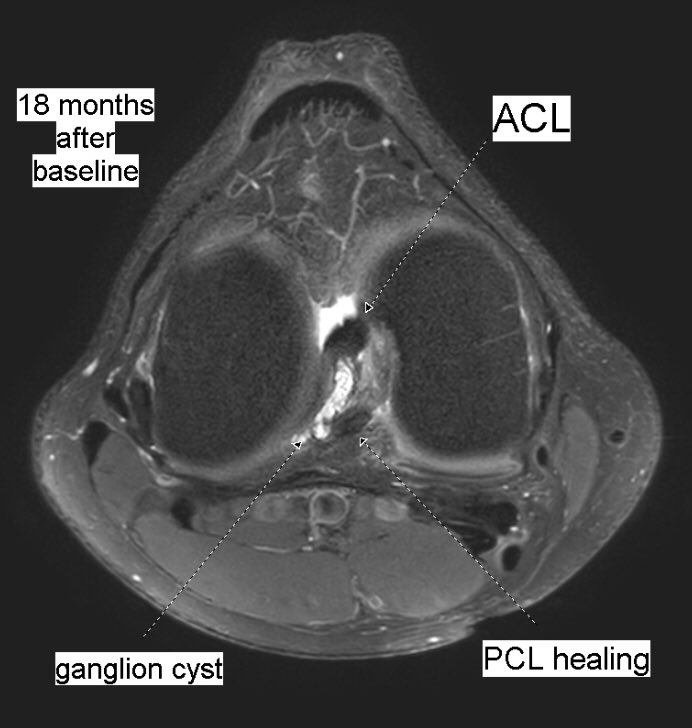 Pcl Ganglion Cyst Mri