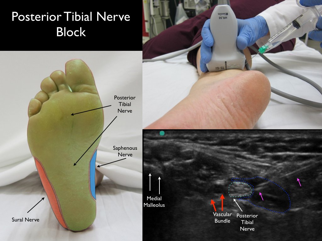 Posterior Tibial Nerve
