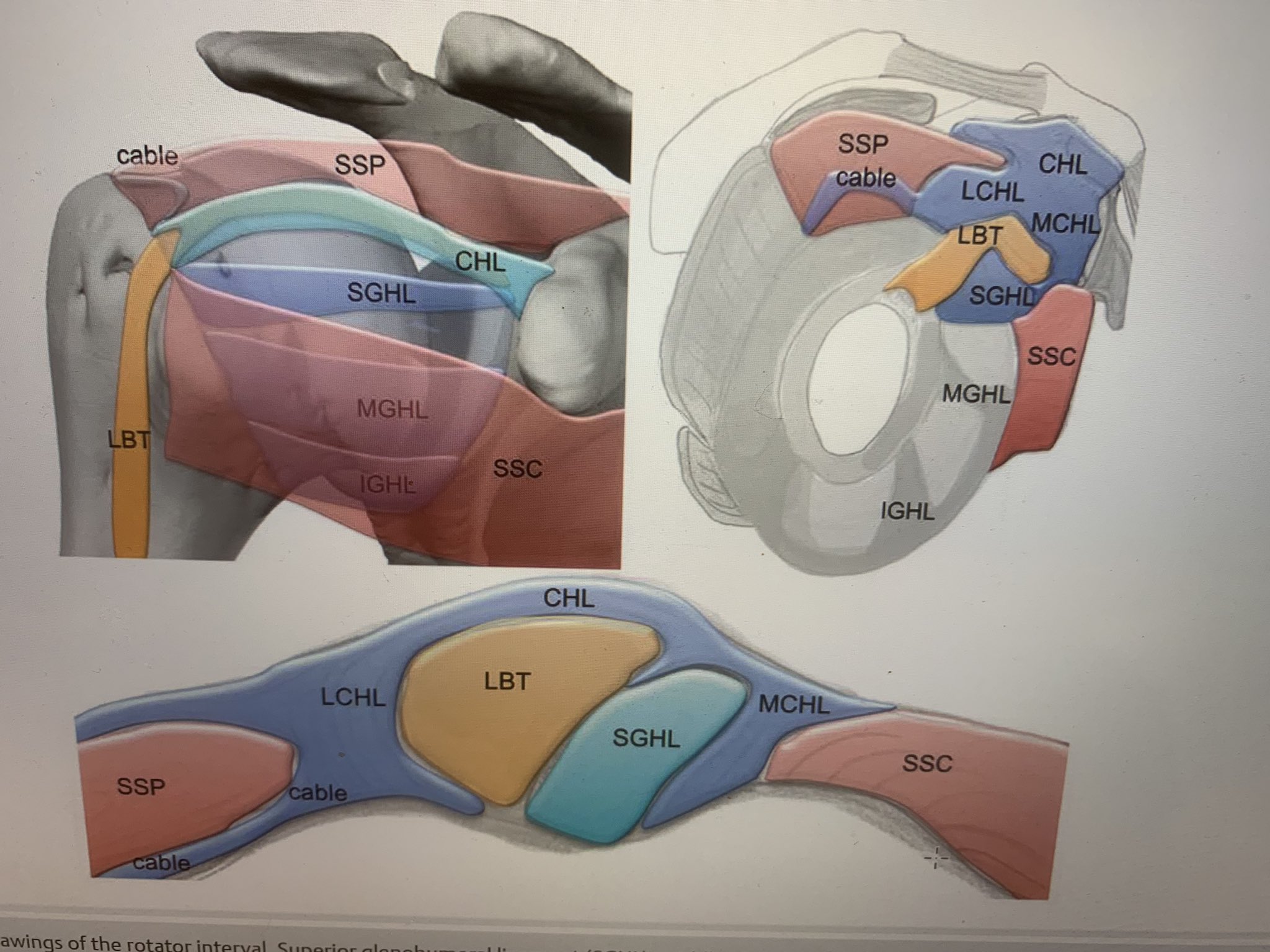 Ramp Lesion Subtypes: Prevalence, Imaging, And Arthroscopic, 46% OFF
