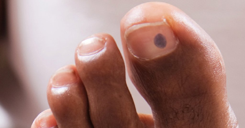 Healthy Toenail Color