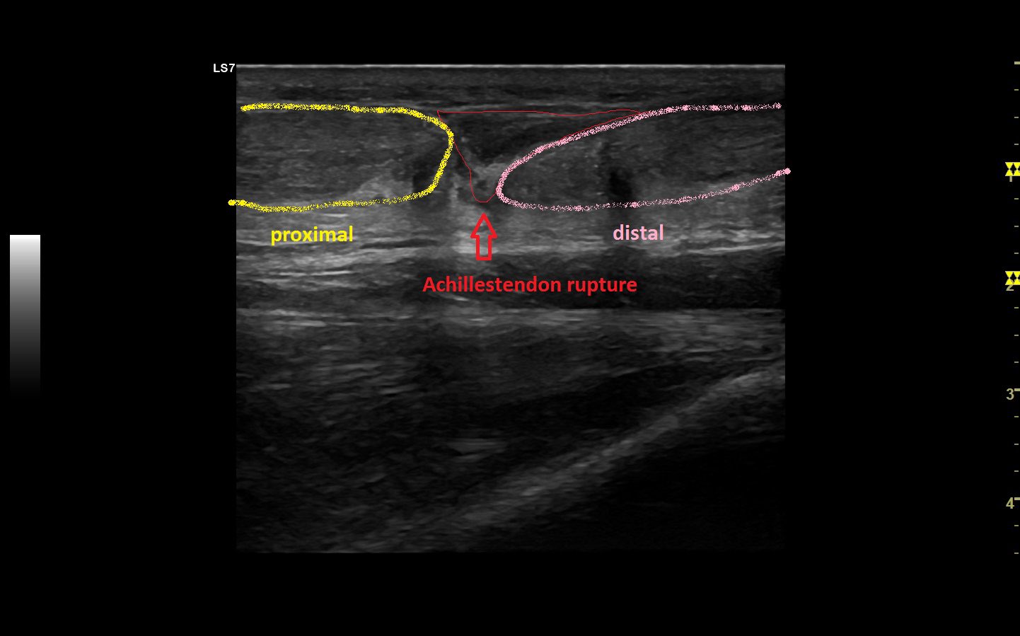 Achilles Tendon Tear Ultrasound