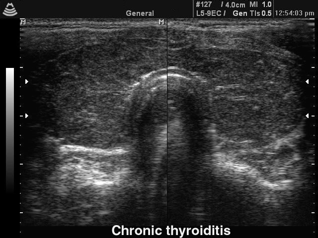 Hashimotos Thyroid Ultrasound