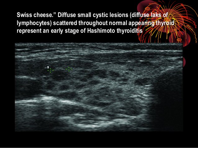 Hashimotos Thyroiditis Ultrasound