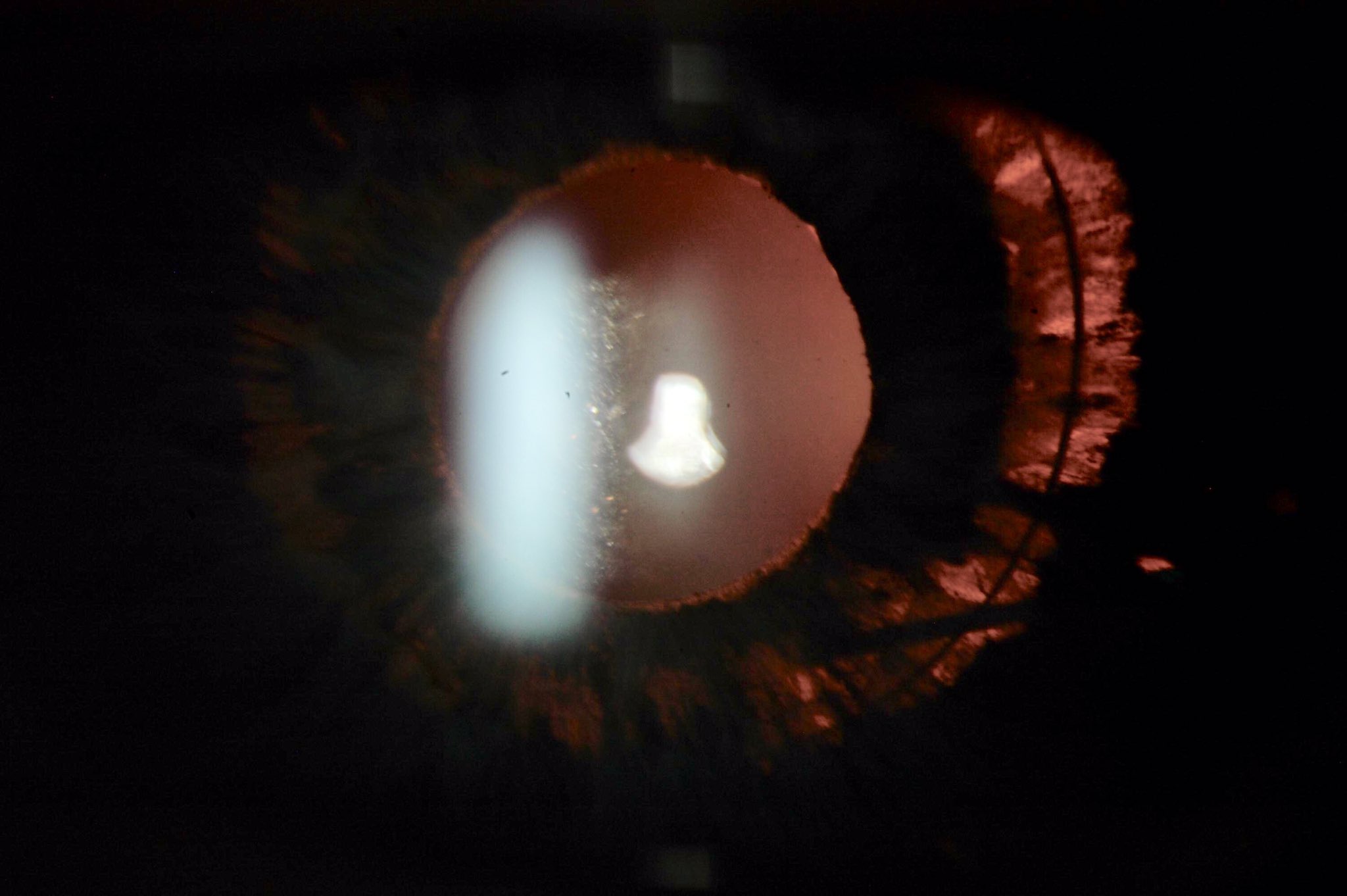 Iris Transillumination Defects