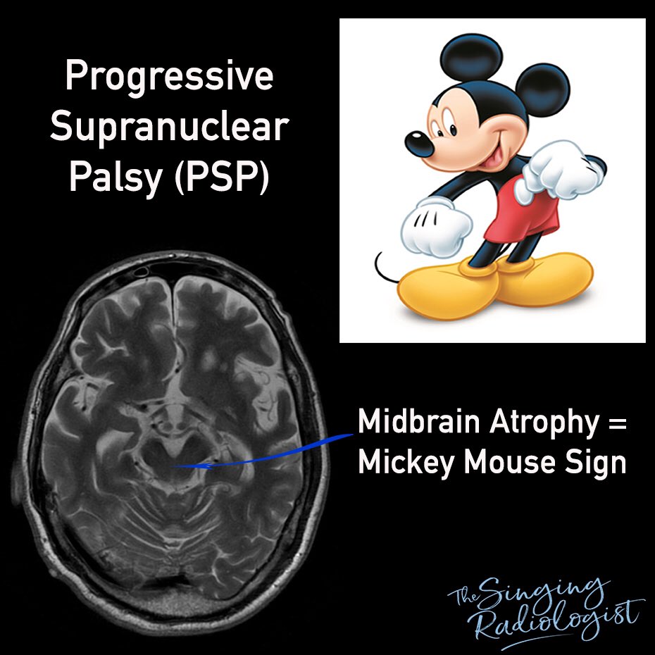 Peeling Megalopoli linea mickey mouse sign piastrella Magazzino camminare