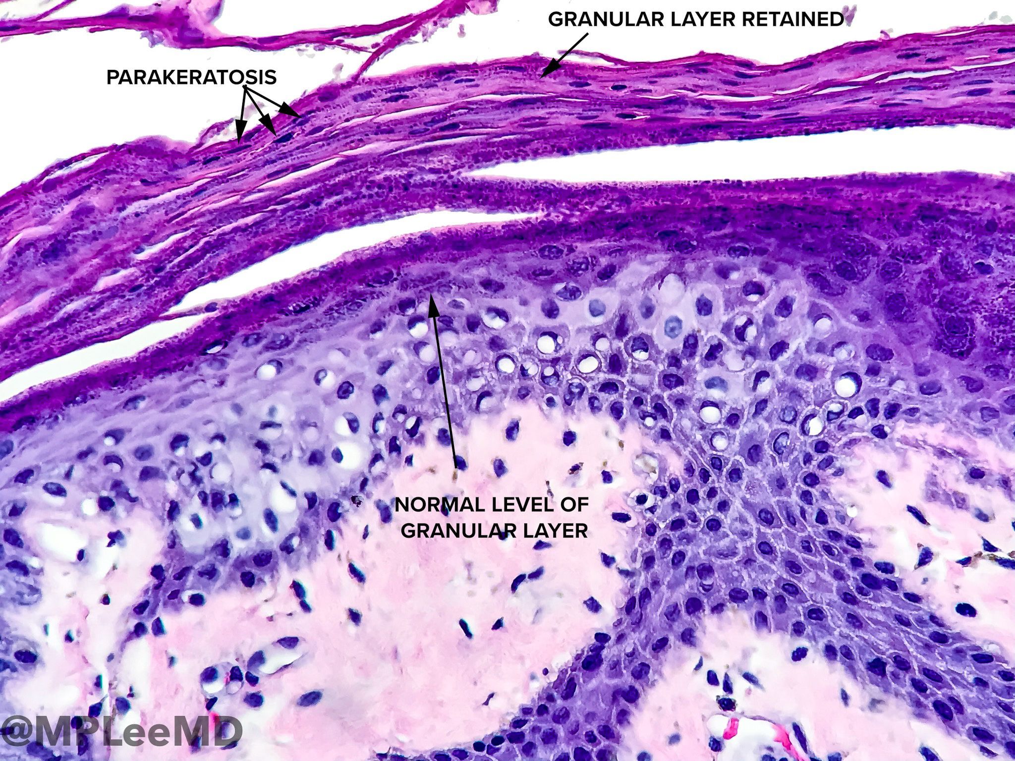 Granular Parakeratosis Histology