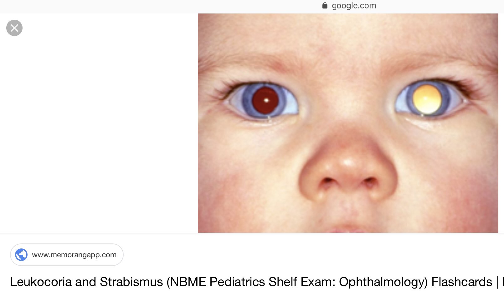 Leukocoria And Strabismus