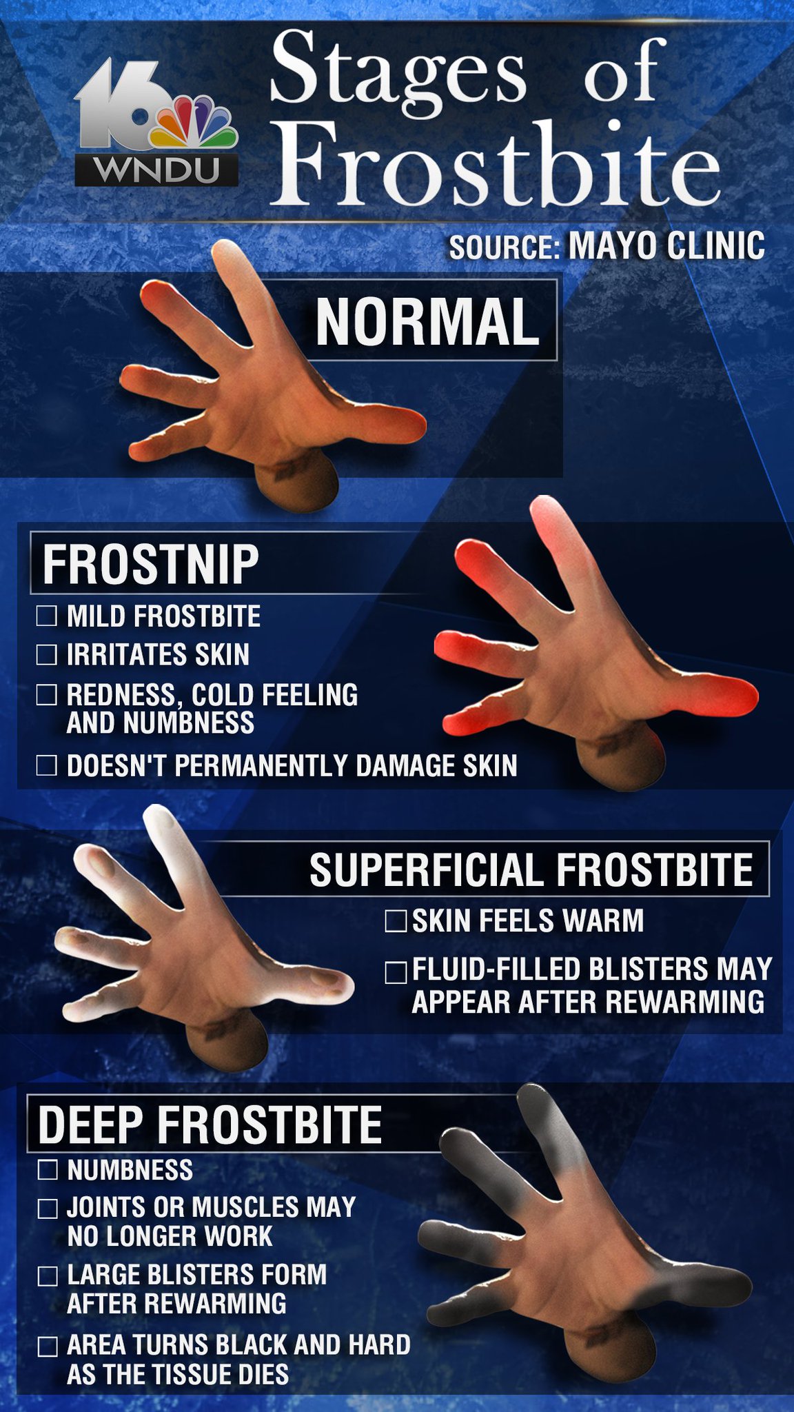 Stages Of Frostbite