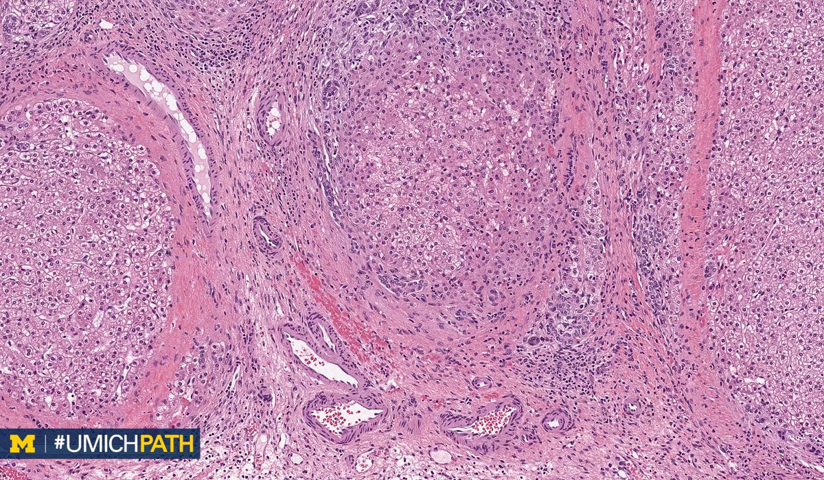 Focal Nodular Hyperplasia Histology Pituitary Gland Hyperplasia