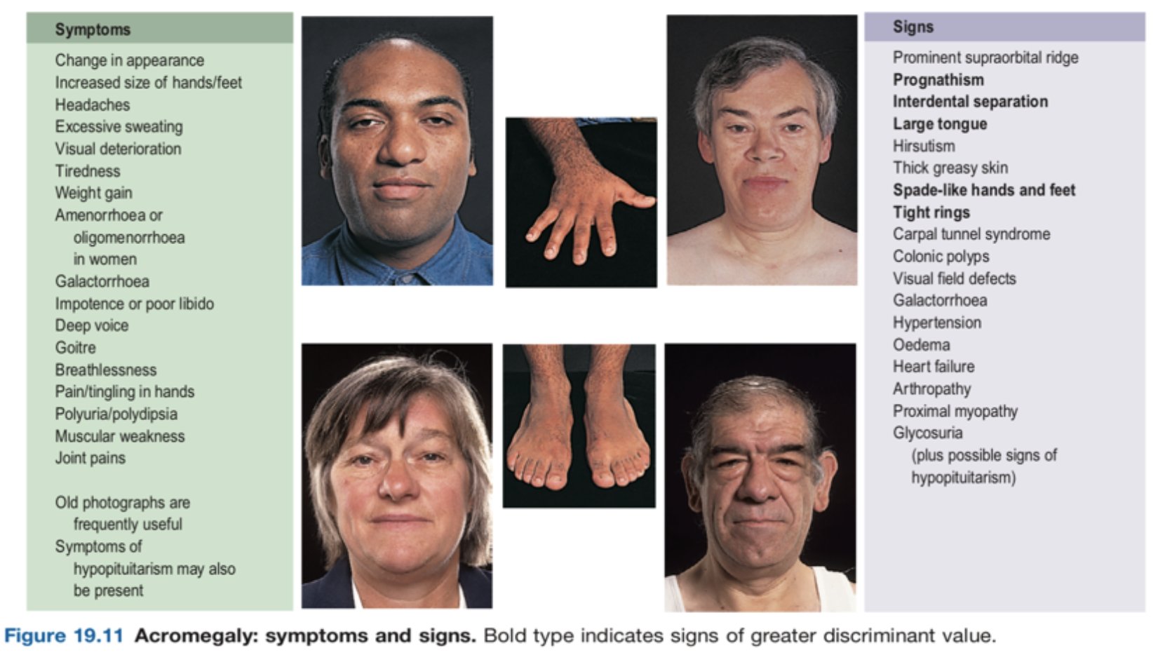 Acromegaly Women