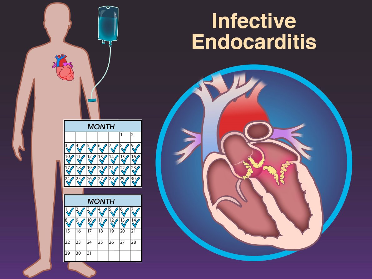 Endocarditis Ecg