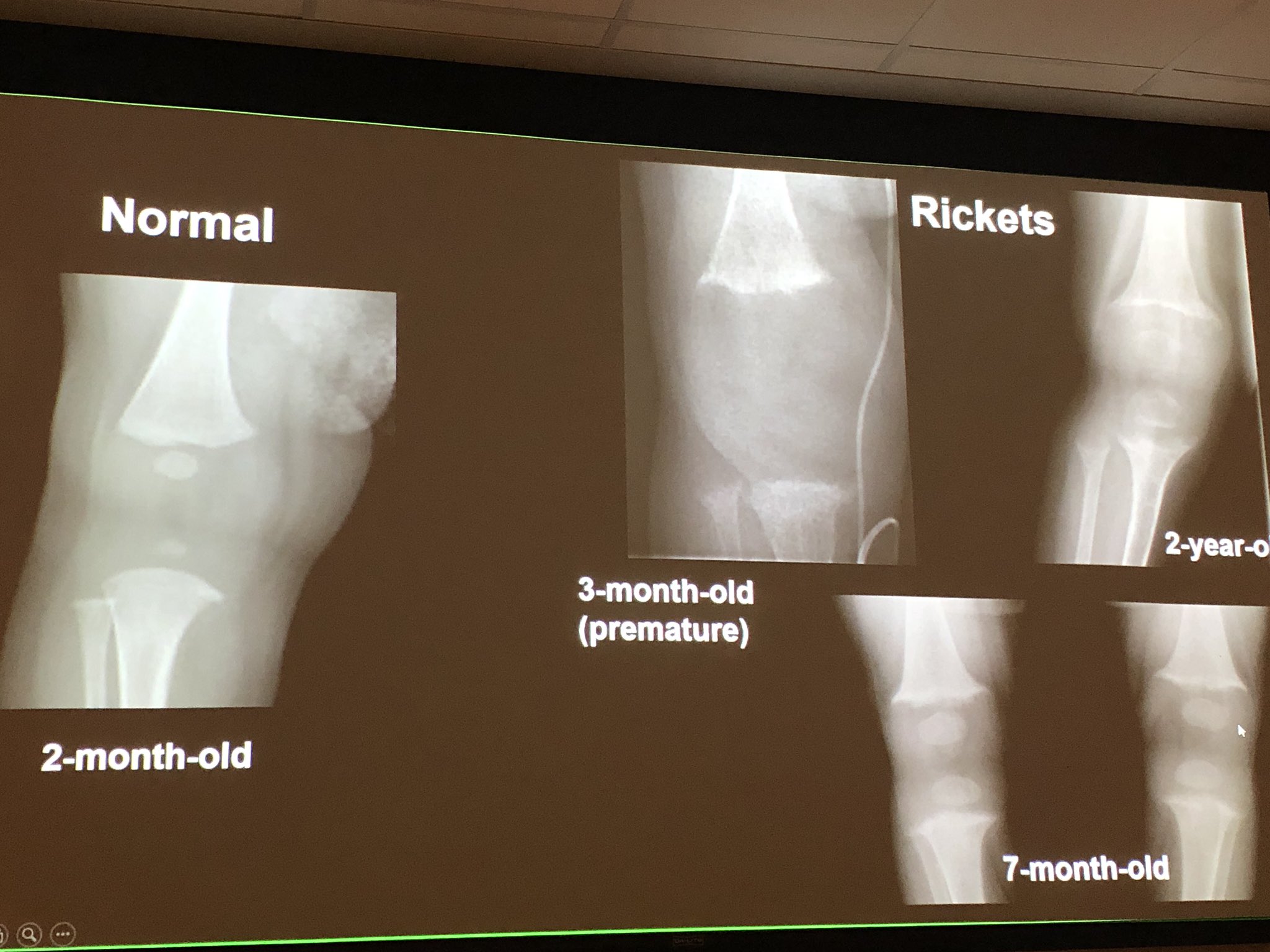 Rickets X Ray