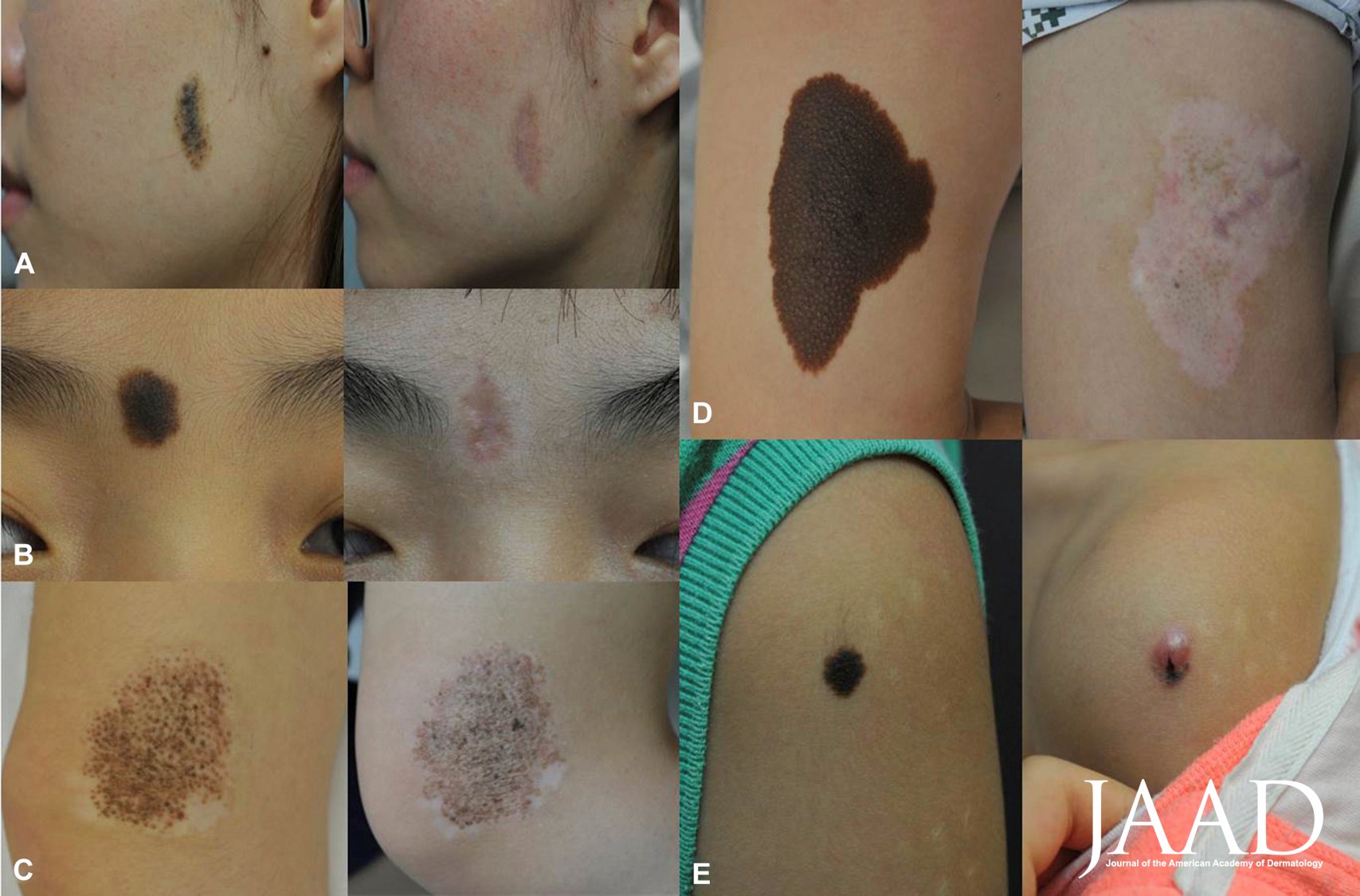 Congenital Nevus Removal Before And After