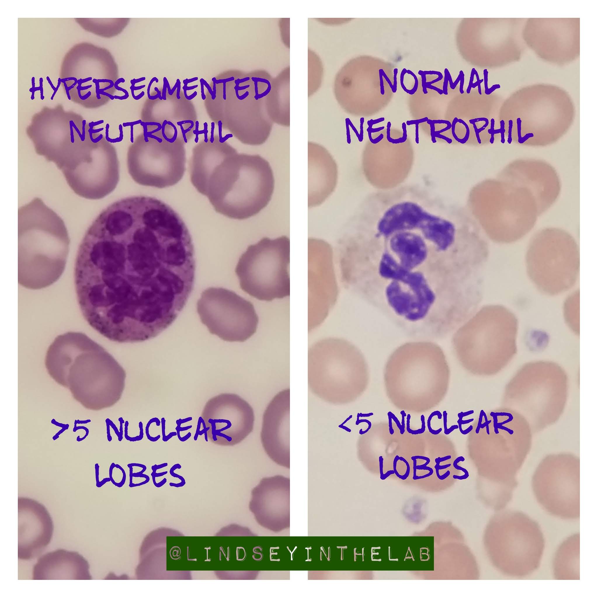 Megaloblastic Anemia Peripheral Smear