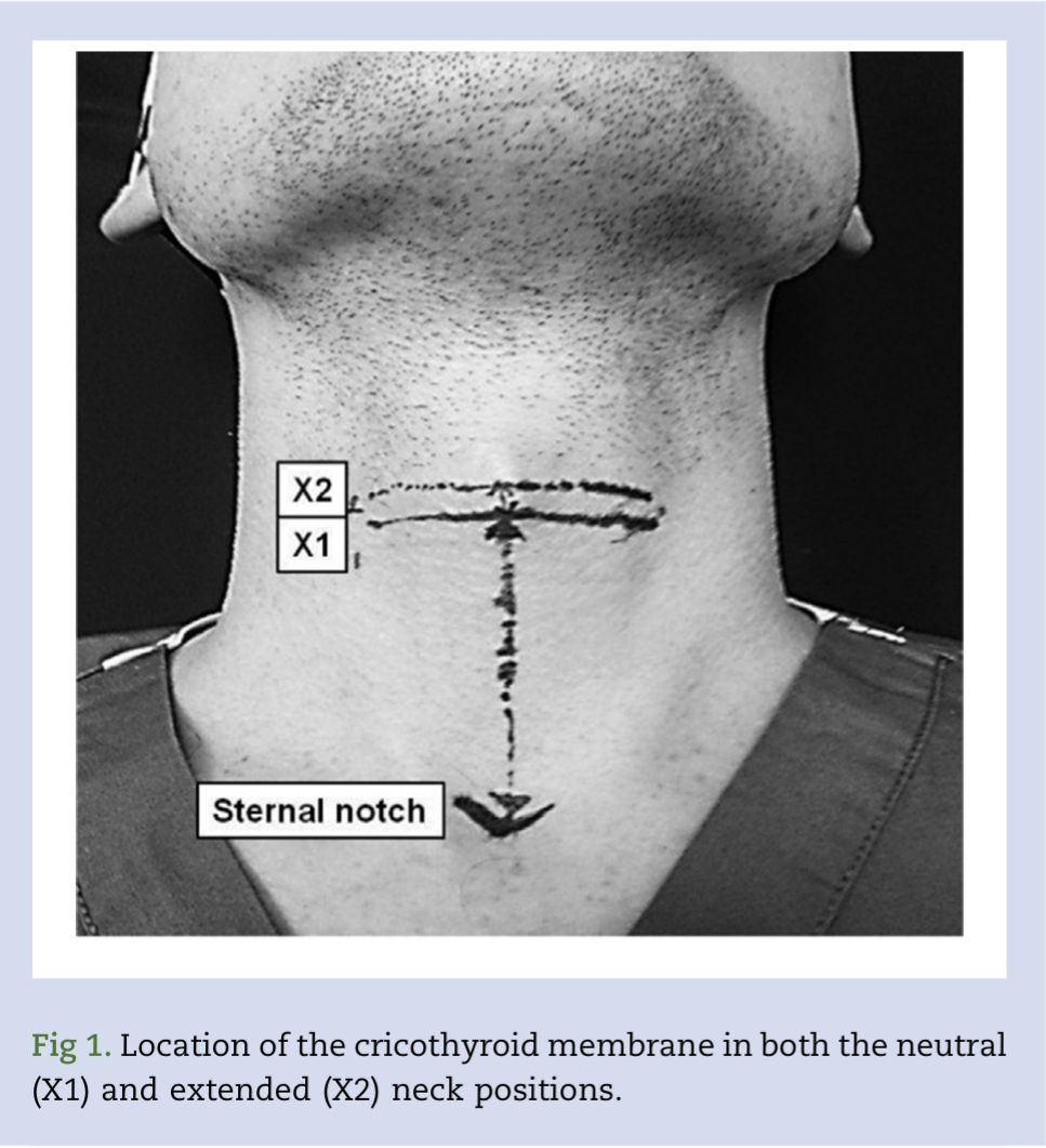 Cricothyroid Membrane Incision