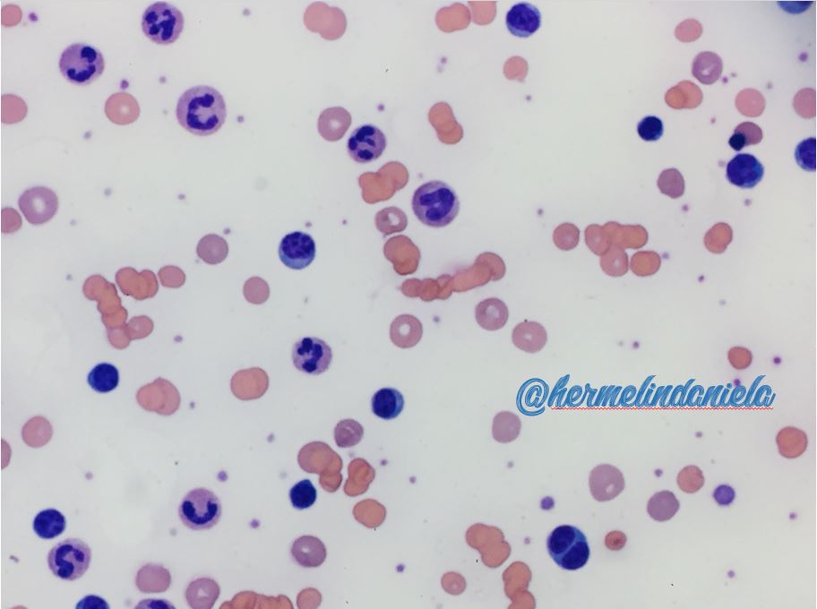 Rbc Agglutination