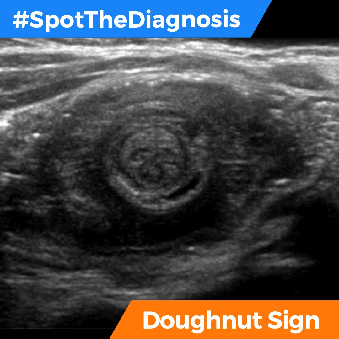 Intussusception Target Sign