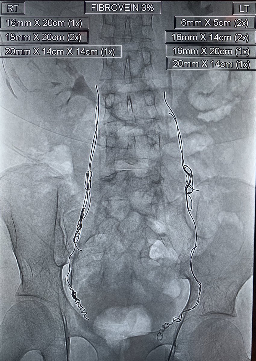 Varicocele Embolization