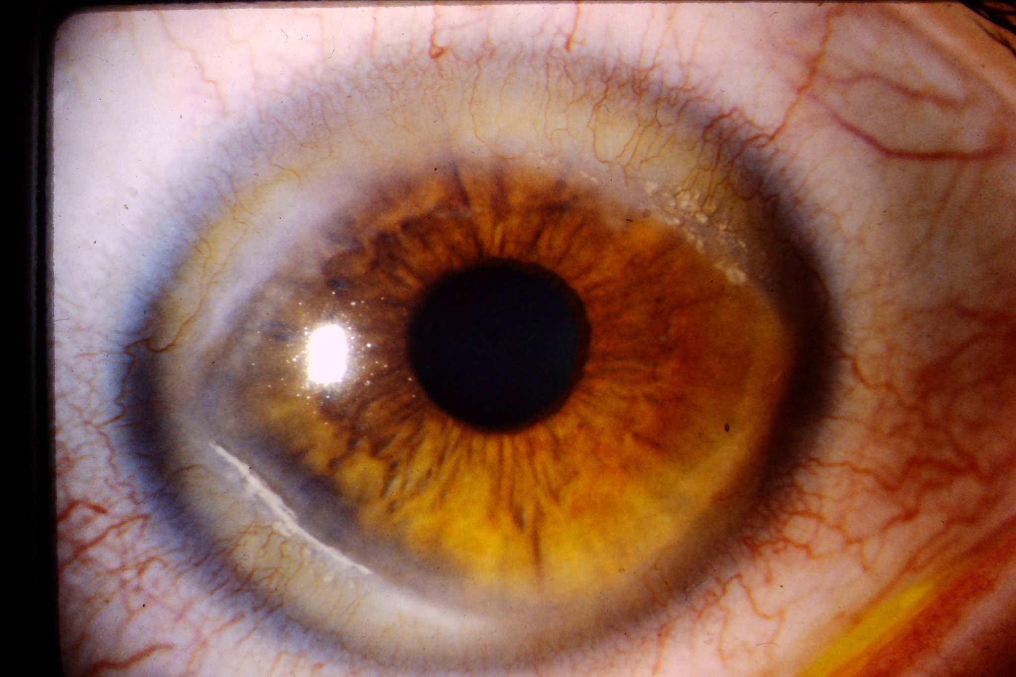 Marginal Corneal Degeneration
