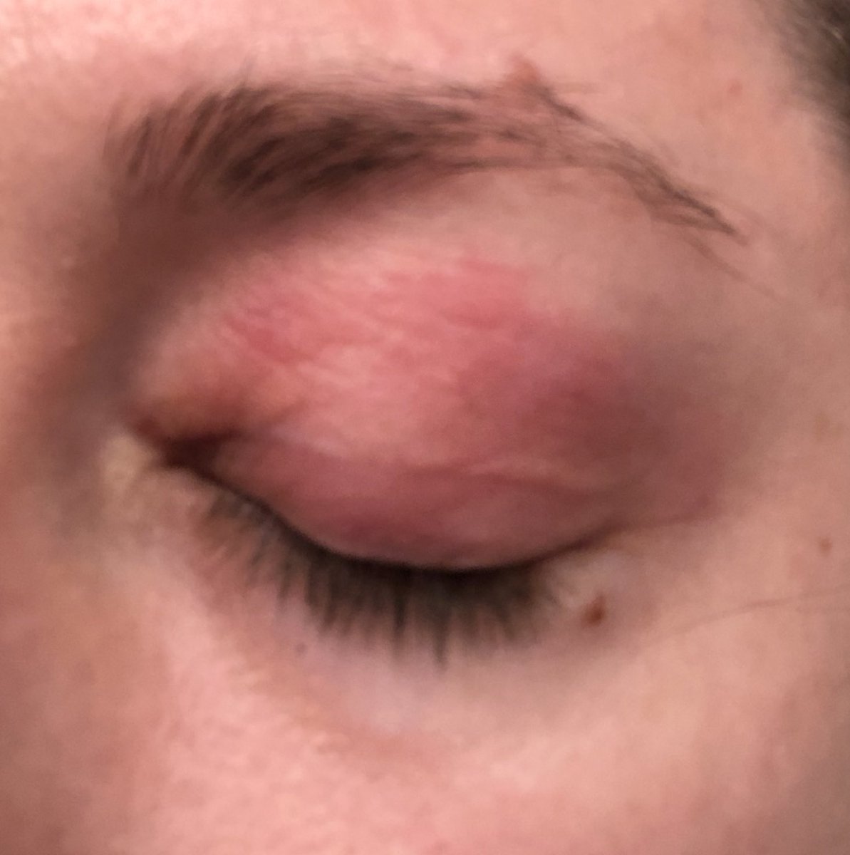 Eye Makeup Allergy Symptoms