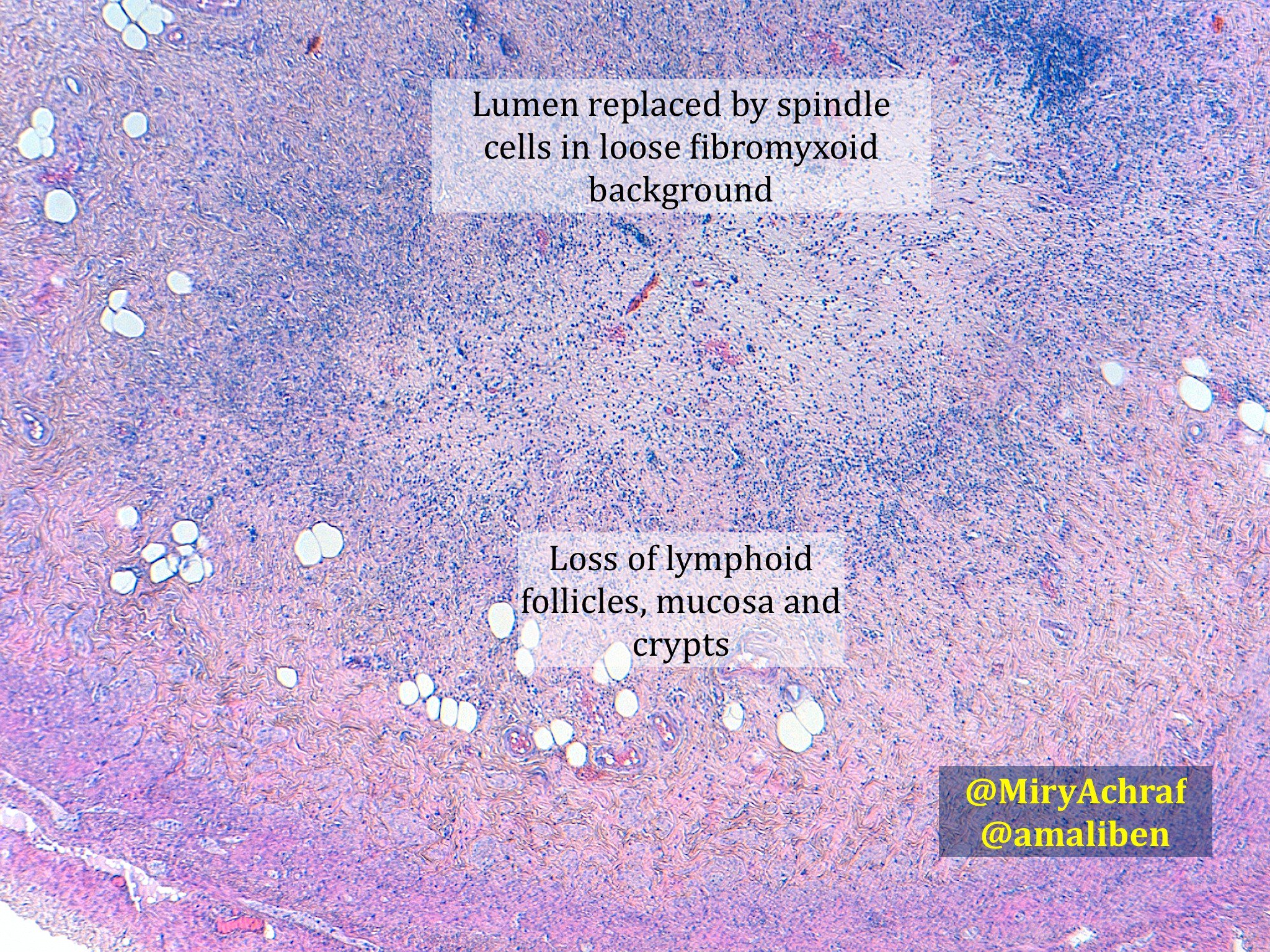 Appendix Histology Labeled A,B, Appendix With Obstructive