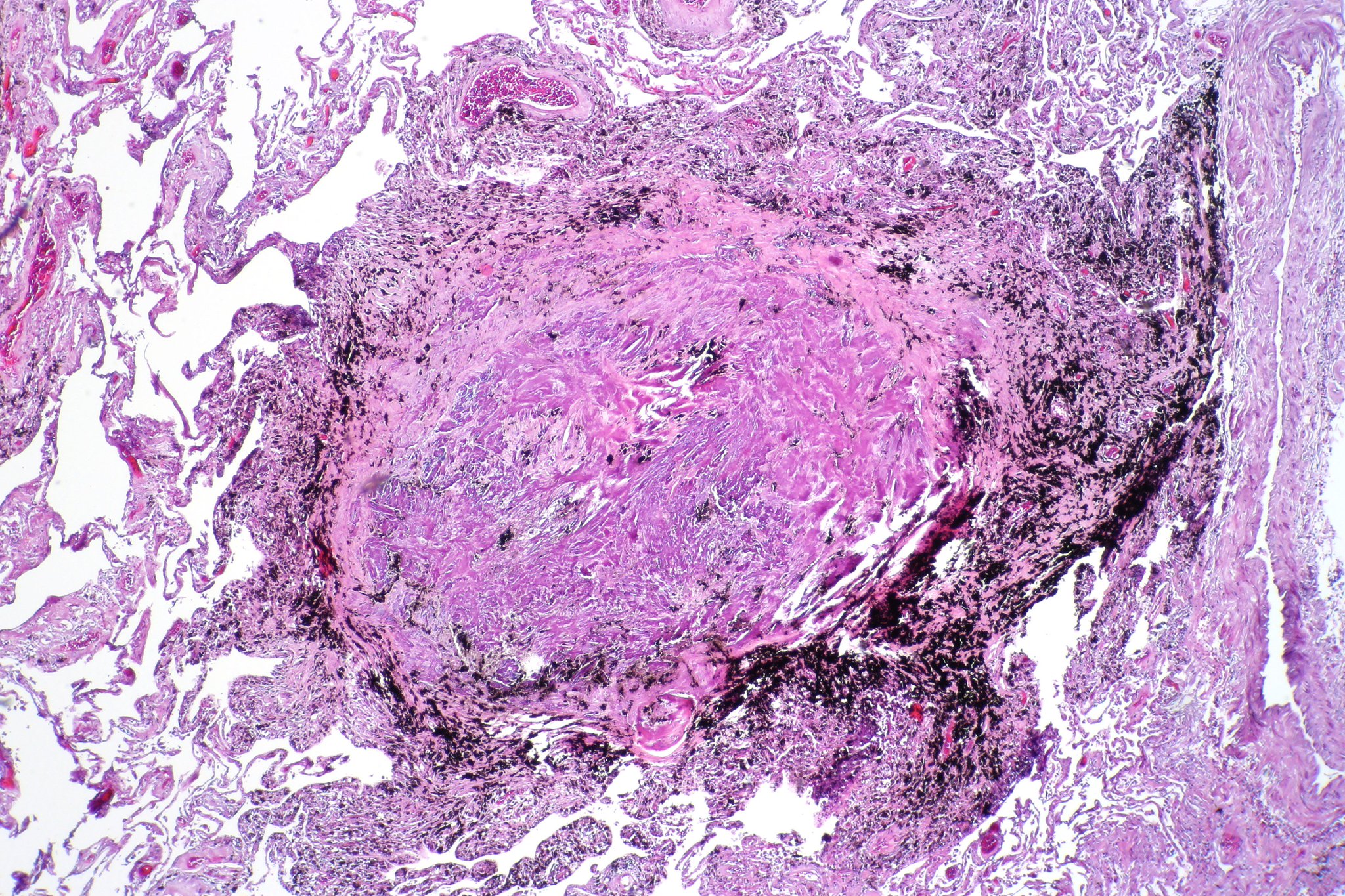 Silicosis Histology