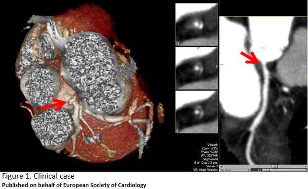 European Society Of Cardiology Journals On Twitter Cardiooncology
