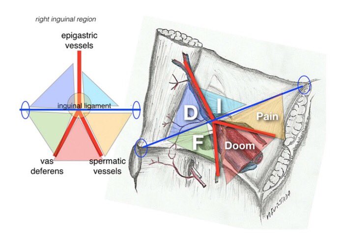 Iliopubic Tract Repair Of Inguinal And Femoral Hernia The