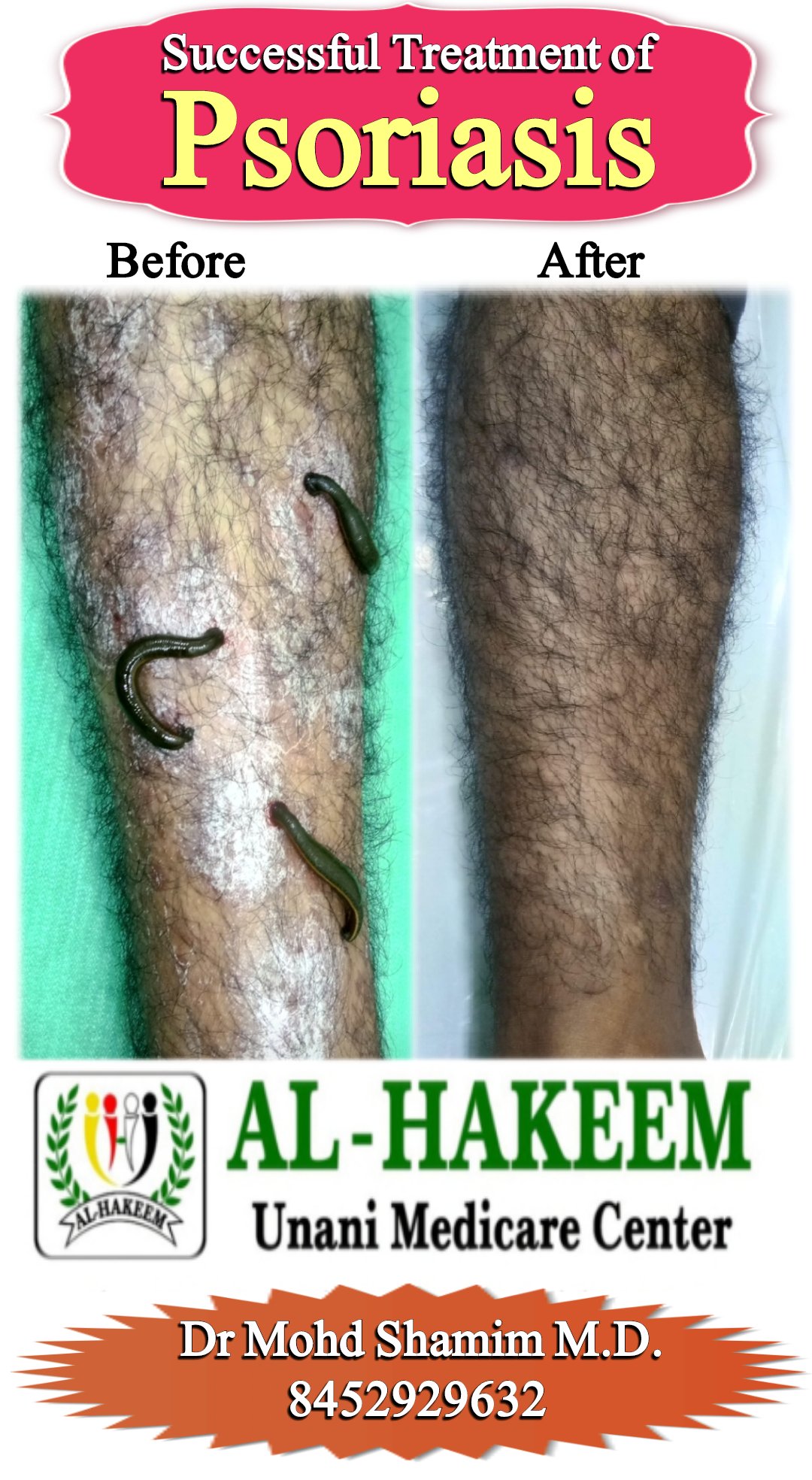 Leech Therapy Before And After