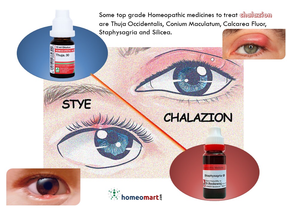 Stye Treatment Over The Counter