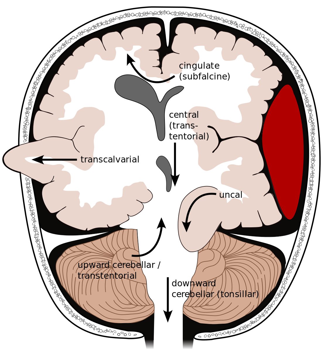 Paramedian Artery