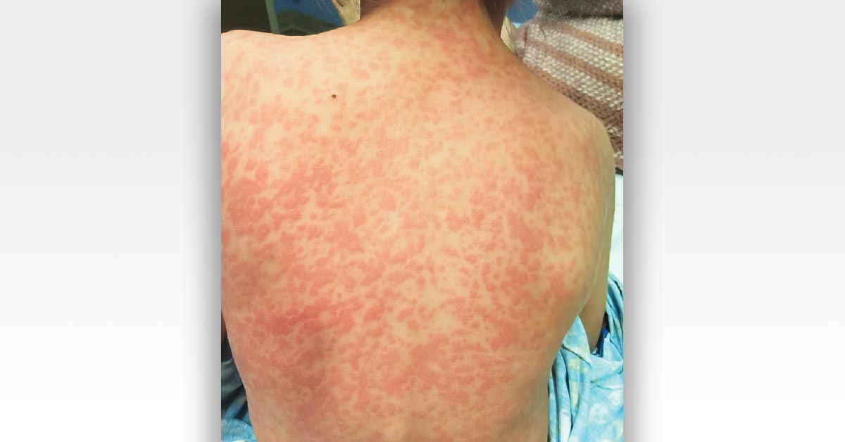 Ebv Rash Amoxicillin Ebv Rash Amoxicillin