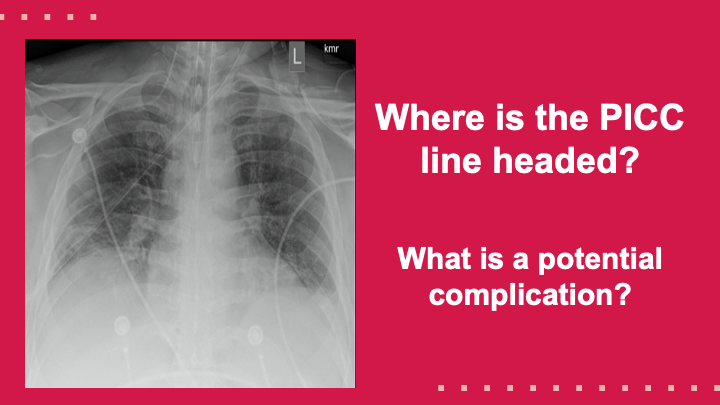 Picc In Innominate Vein