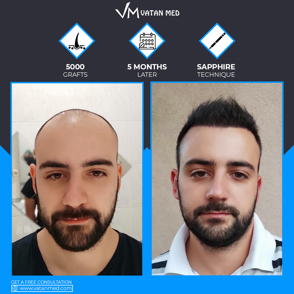Hair Transplant Before And After 5000 Grafts
