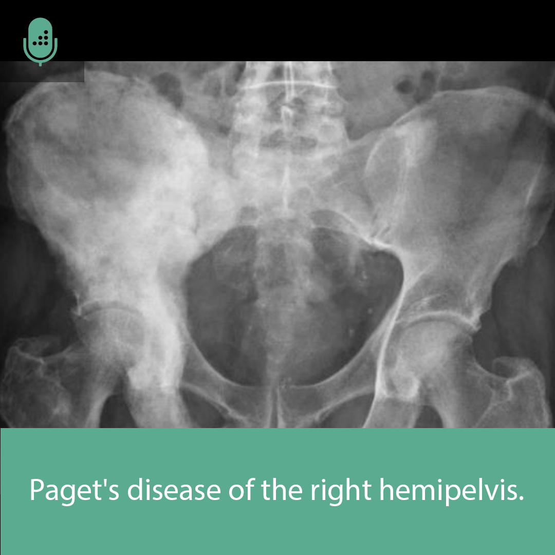 Imaging Of Paget Disease Of Bone And Its Musculoskeletal Complications ...
